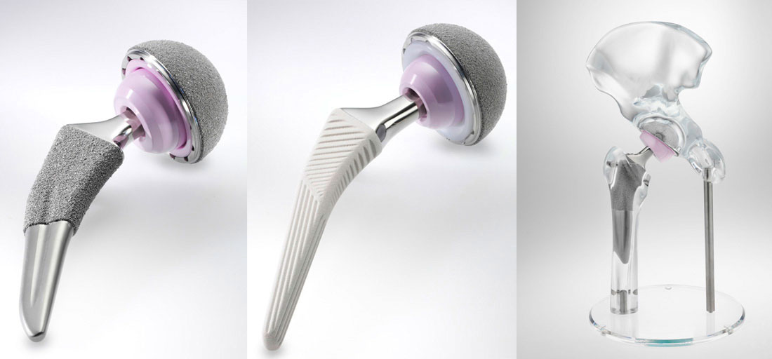 AMIS-Hüftprothese - Orthoprax